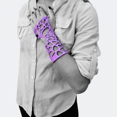 Biodegradable 3D printed splints as alternative to a cast ...